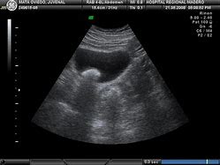 Cálculo Vesical - IUN - Urologia